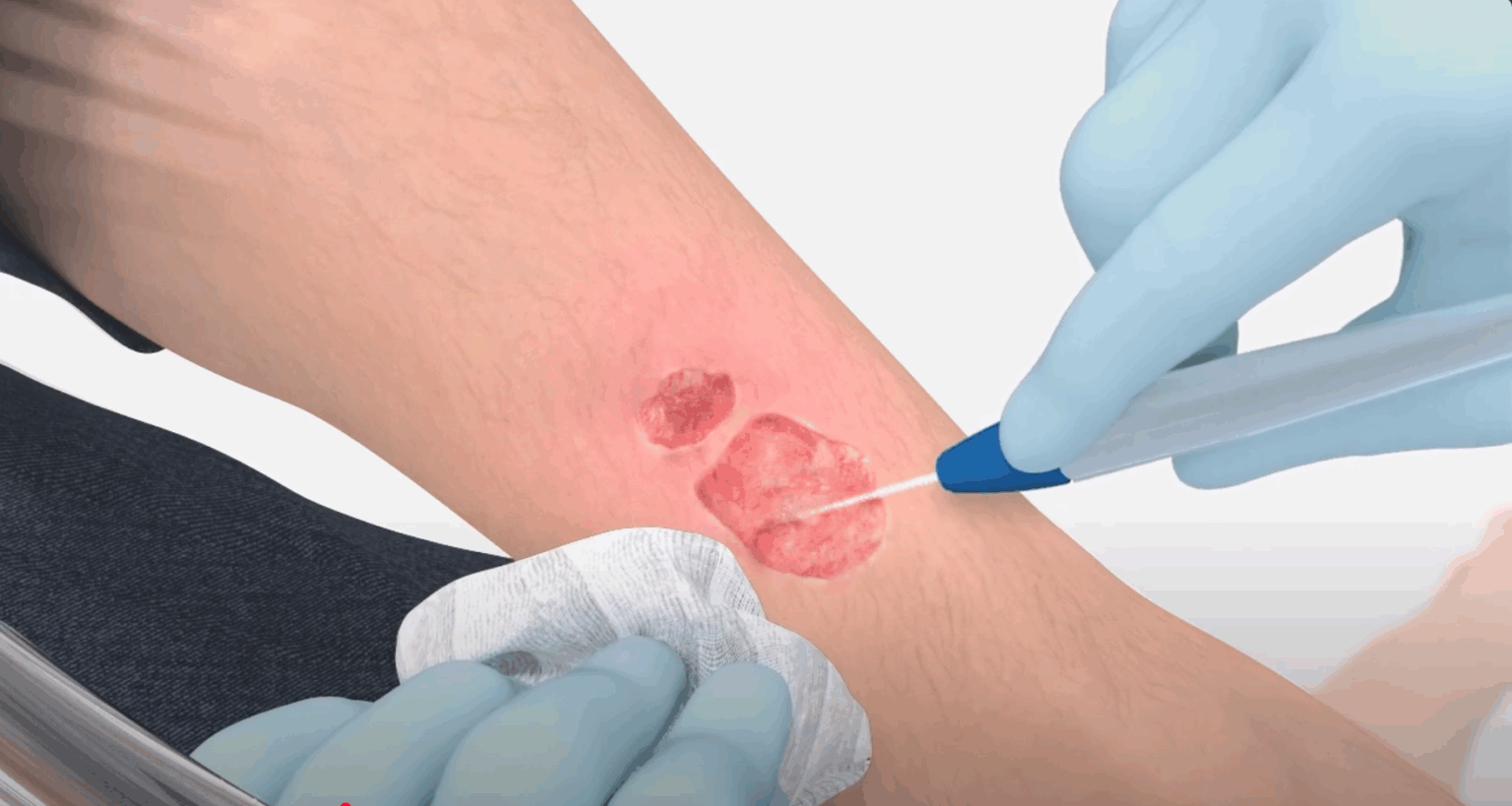 Microjet Wound Therapy - Medaxis